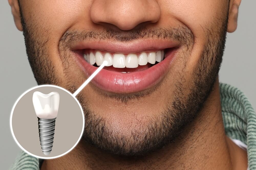 Prednosti zubnih implantata || LUMIDENT STUDIO