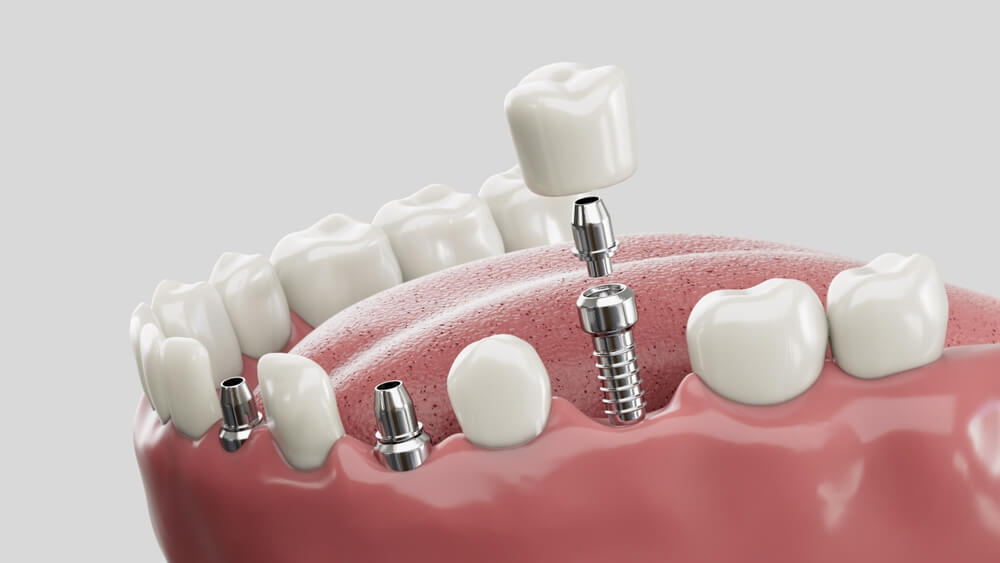 Zubni implantati || LUMIDENT STUDIO